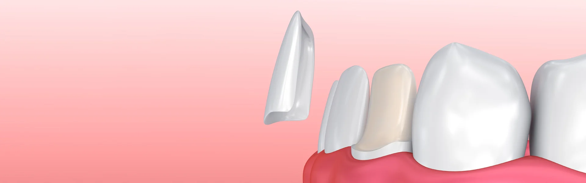 The Porcelain Veneers Process: Step-by-Step Guide from Consultation to ...
